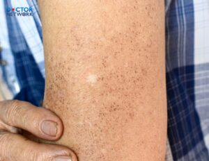 Top 5 common causes of brown spots on the hands - Doctor Network