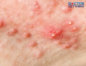 Top 9 Treatment Options for Acne on the Temples You Might Not Know ...