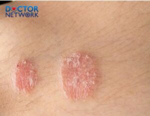 Suffering from red circular patches on the skin due to the following 5 ...