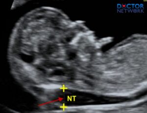 What is the normal nuchal translucency measurement? - Doctor Network