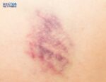 Cause and Management of Subcutaneous Bleeding - Doctor Network