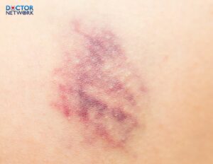 Cause and Management of Subcutaneous Bleeding - Doctor Network