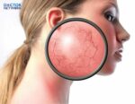 5 harmful effects of corticosteroids on the skin that you need to know ...