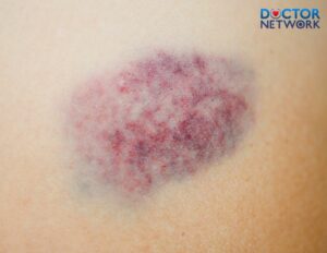 4 fastest ways to get rid of bruises you should know! - Doctor Network