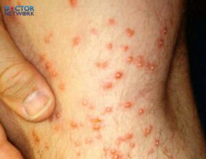 Signs of ant bites you need to know - Doctor Network