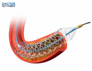 How long do people with coronary stents live? - Doctor Network