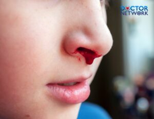 7 most common causes of nosebleeds in children - Doctor Network