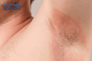 Why Are My Armpits Itchy? Learn about deodorant reactions, fungal ...